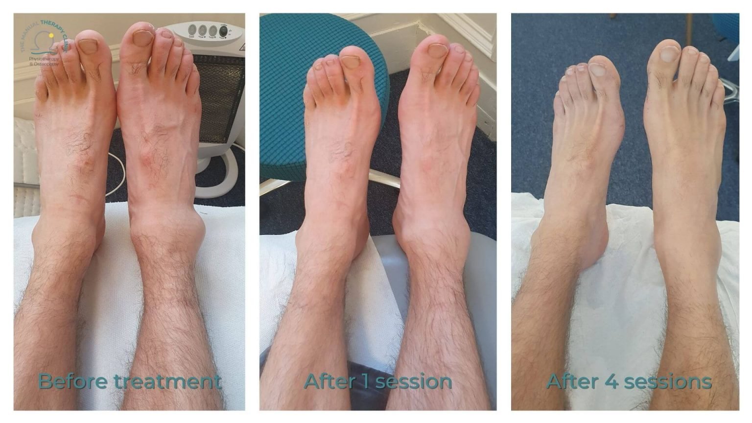 INDIBA - Radiofrequency therapy