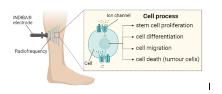 INDIBA - Radiofrequency therapy